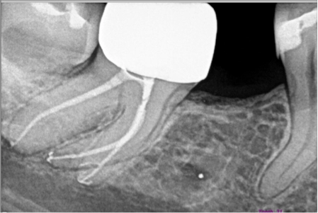 Endodontics - Pinnacle Endodontics of Crabapple